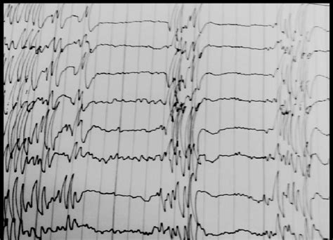 Burst Suppression Pattern On Eeg Download Scientific Diagram
