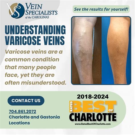 Understanding Varicose Veins Faqs From Vein Specialists Of The