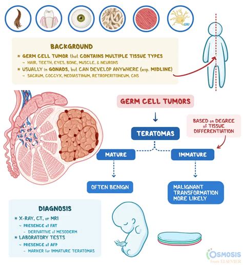 Teratoma What Is It Signs Symptoms And More Osmosis