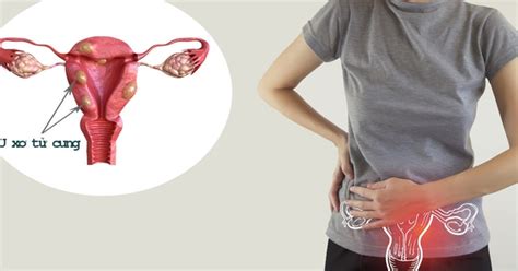 Tổng hợp những triệu chứng bệnh u nang tử cung ảnh hưởng đến sức khỏe phụ nữ