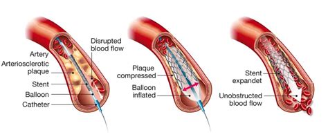 Coronary Angioplasty When Do Doctors Recommend It