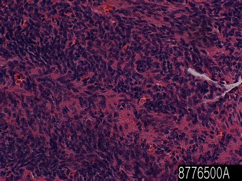 Thyroid Chronic Lymphocytic Thyroiditis Xelonet