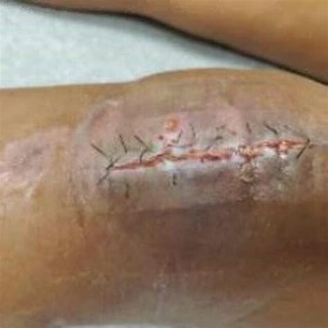 Incisional Dehiscence After Initial Open Reduction And Internal