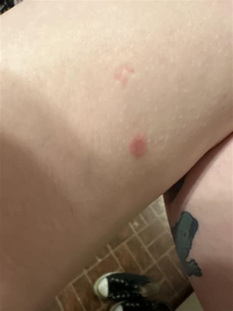 Does Doxycycline Make You Wicked Sick R Lymedisease