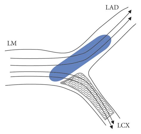 Schematic Diagrams Of Lm Bifurcation According To Different Lm Lad Download Scientific Diagram