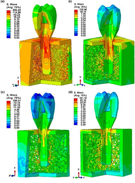 Figure 1 From Advancing 3d Dental Implant Finite Element Analysis