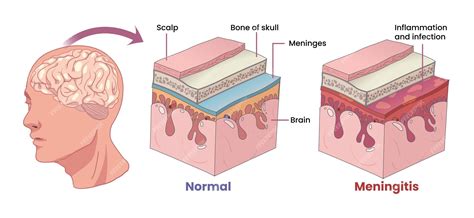 Premium Vector Illustration Of Meningitis Inflammation Membranes