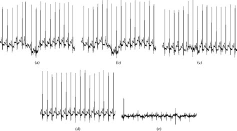 Figure 1 From On Ecg Signal Compression With 1 D Multiscale Recurrent Patterns Allied To