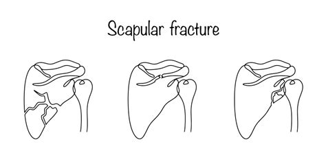 Metacarpal Fracture Royalty Free Vector Image Vectorstock Metacarpal Fracture Royalty Free Vector Image Vectorstock