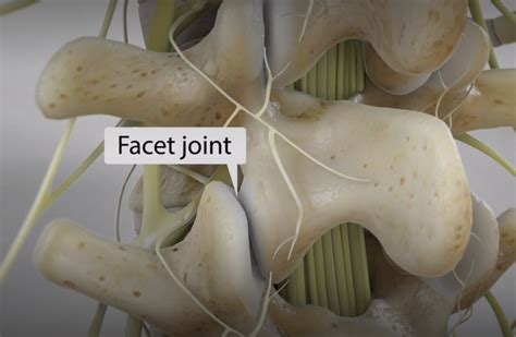 Facet Joint Pain Q Spine