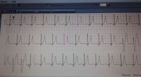 Looks Like Normal Sinus Rhythm Mostly But What Are The Two Beats Far Right Middle Row And