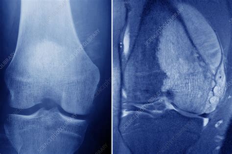 Osteosarcoma Of The Knee X Ray And Mri Scan Stock Image C061 5880 Science Photo Library