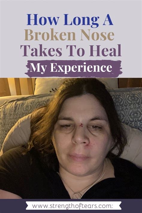 What Does A Healed Broken Nose Look Like At Anthony Griggs Blog