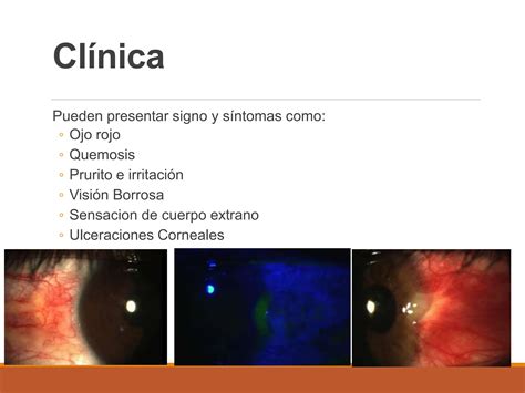 Que Es Pterigion Clasificacion Clínica Pptx