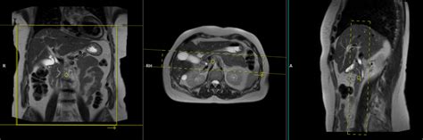 Mrcp Planning Mrcp Protocols Indications For Mri Cholangiopancreatography