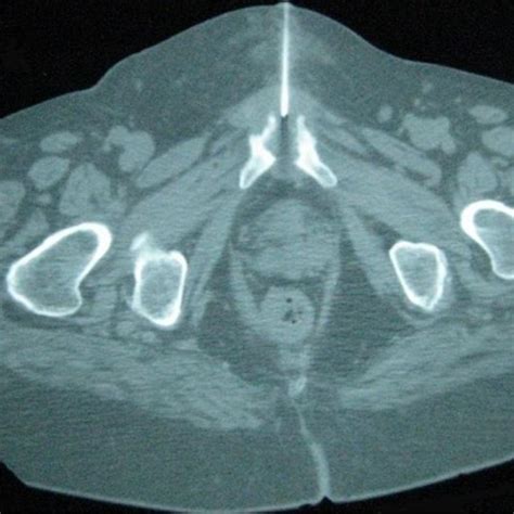 Puncture Biopsy Of The Pubic Symphysis Under Ct In A Patient With An