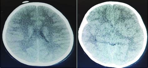 Brain Ct Scan Revealing Mild Sulcal Effacement Download Scientific Diagram