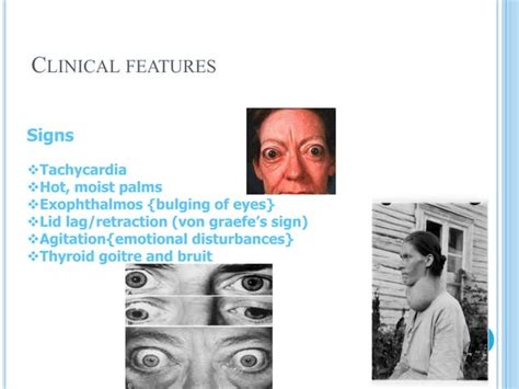 Grave Disease Also Called Basedows Disease Pptx