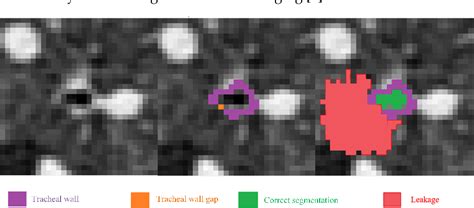 Figure 1 From A Precise Pulmonary Airway Tree Segmentation Method Using