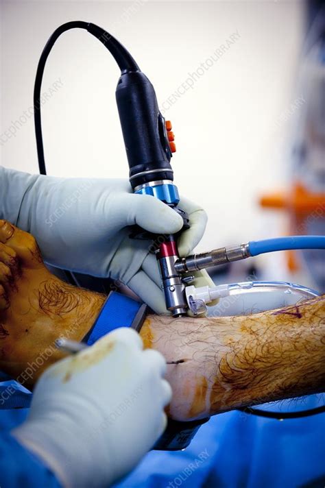 Ankle Arthroscopy Stock Image C008 5203 Science Photo Library