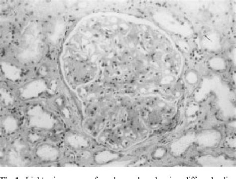 Figure 1 From Nodular Glomerulosclerosis After Renal Transplantation Without Diabetes Mellitus
