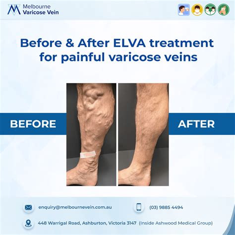 Melbourne Varicose Vein Melbourne Varicose Vein Clinic • Instagram Photos And Videos