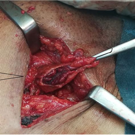 Picture Showing Appendix After Opening Hernial Sack Download