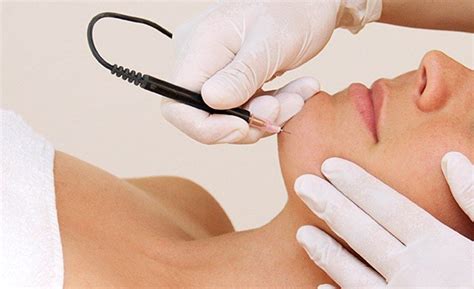 Electrolysis Permanent Hair Removal Mornington Peninsula — Regenerate