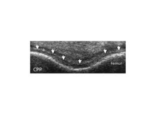 CPPD Arthropathy Rheumatology Advisor