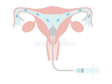 Hysterosalpingography For Fertility Treatment A State In Which A Contrast Medium Is Placed In