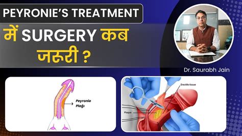 Peyronies Disease में Surgery की जरूरत कब होती है जब लिंग का टेढ़ापन इतना ज्यादा हो जाए