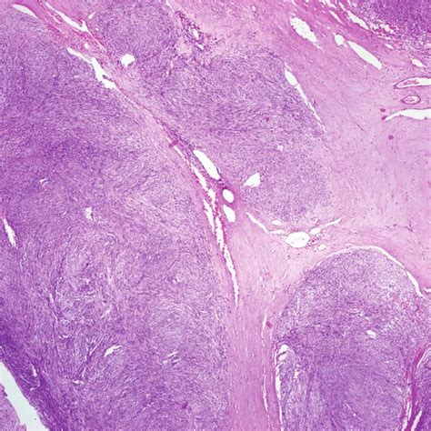 Computerized Tomography An Enlarged Prostate Showing Calcifications Download Scientific