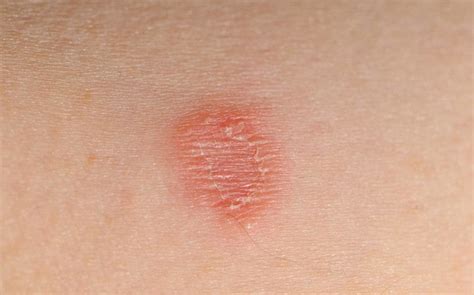 A Guide For Members To Recognize Prevent And Treat Ringworm And Staph