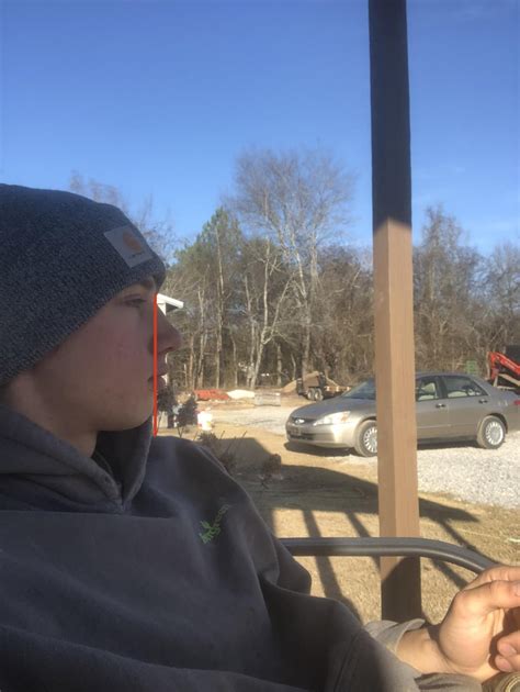 Recessed Maxilla Causing Weak Chin Rmewing