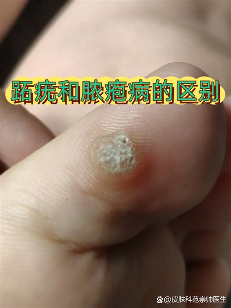 跖疣和脓疱病的区别