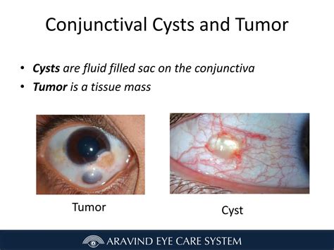 Diseases And Disorders Of Conjunctiva Pptx