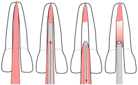Gutta Percha And Updated Obturating Techniques Medcrave Online