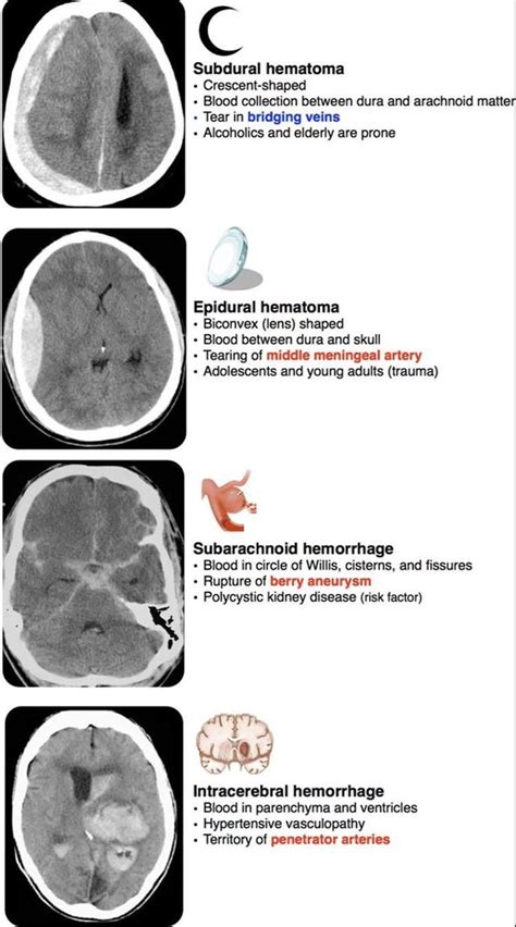 Contusion Vs Hematoma