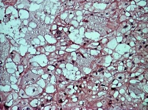 Cords And Lobules Of Physaliferous Cells Separated By Fibrous Septa