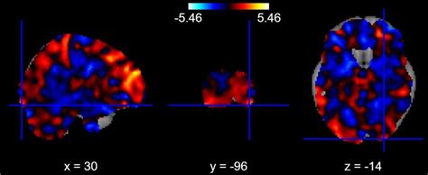 Coordinates Of The Voxel With Maximum Activity In Brodmann Area 17