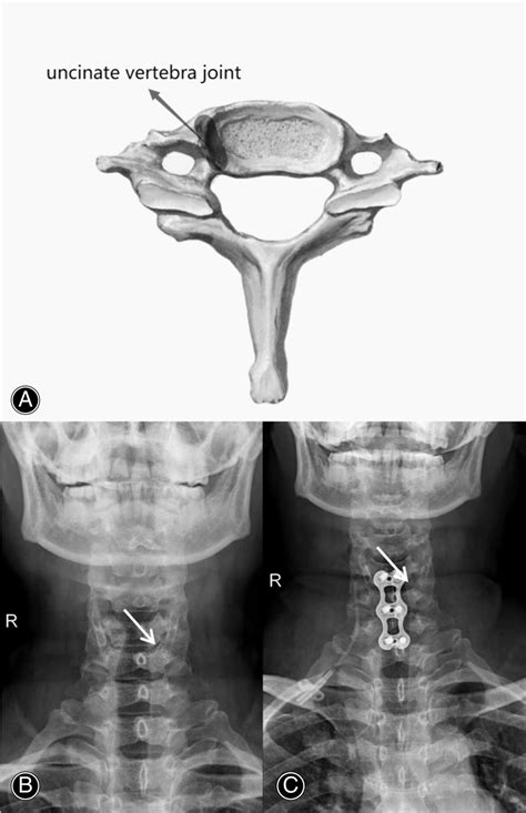 A The Shaded Area Is The Part Where The Uncinate Joint Was Partially