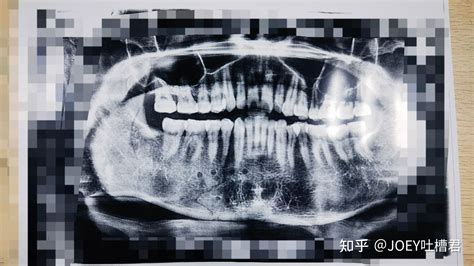 下颌骨骨折的正确处理方法是什么？ 知乎