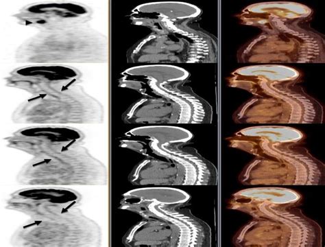 A 72 Year Old Male Patient With Right Pyriform Sinus Scc A Baseline Download Scientific