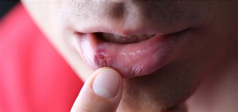 Glositis Síntomas Causas Y Tratamiento