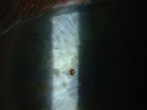 Corneal Rust Ring Removal Corneal Rust Ring Removal