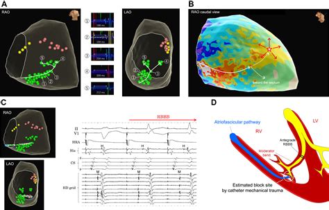 Detailed Delineation And Electrophysiological Assessments Of An