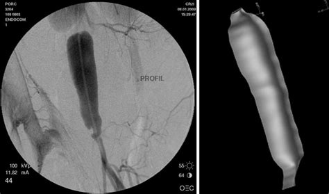 Angiographic View And 3d Reconstruction In One Example Of The Pig Model
