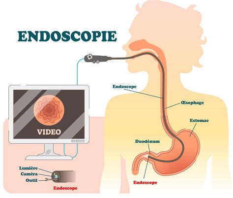 Panendoscopie Les Différents Types Zvnb