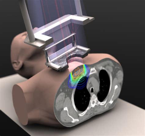 Advancing Radiotherapy With Parallel Computing Computational Visua Tek