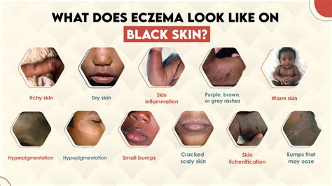 Seborrheic Dermatitis African American Face